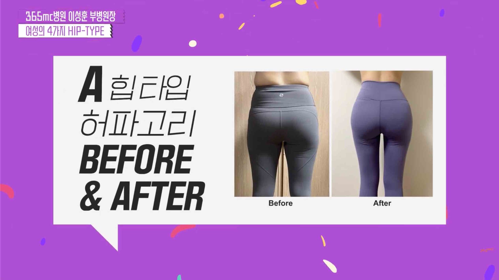 How To Fix Hip Dips (Dimples)? | Liposuction in Korea at 365mc Clinic ...