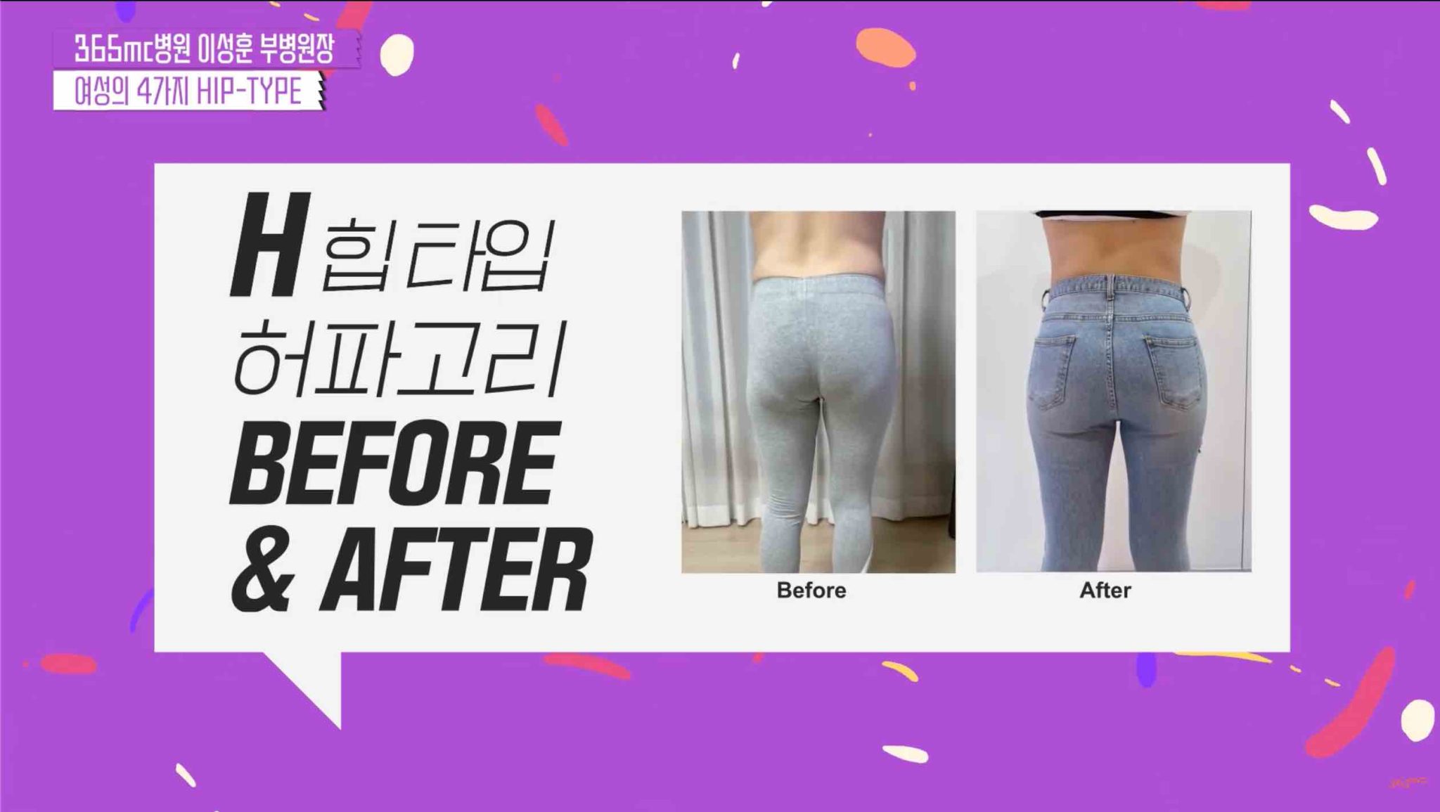 How To Fix Hip Dips (Dimples)? | Liposuction in Korea at 365mc Clinic ...