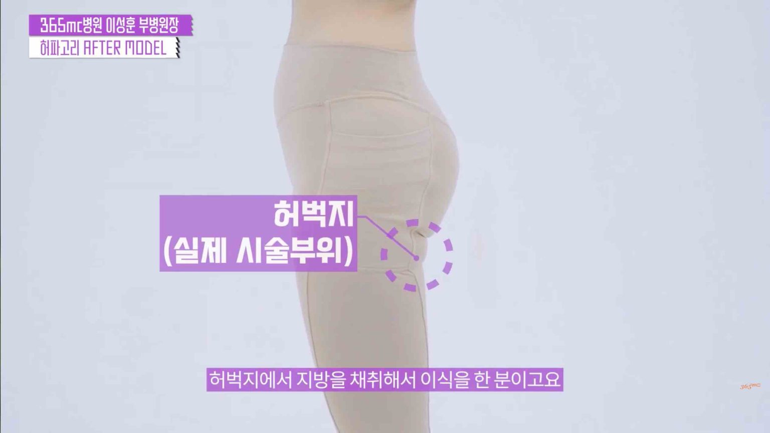 How To Fix Hip Dips (Dimples)? | Liposuction in Korea at 365mc Clinic ...