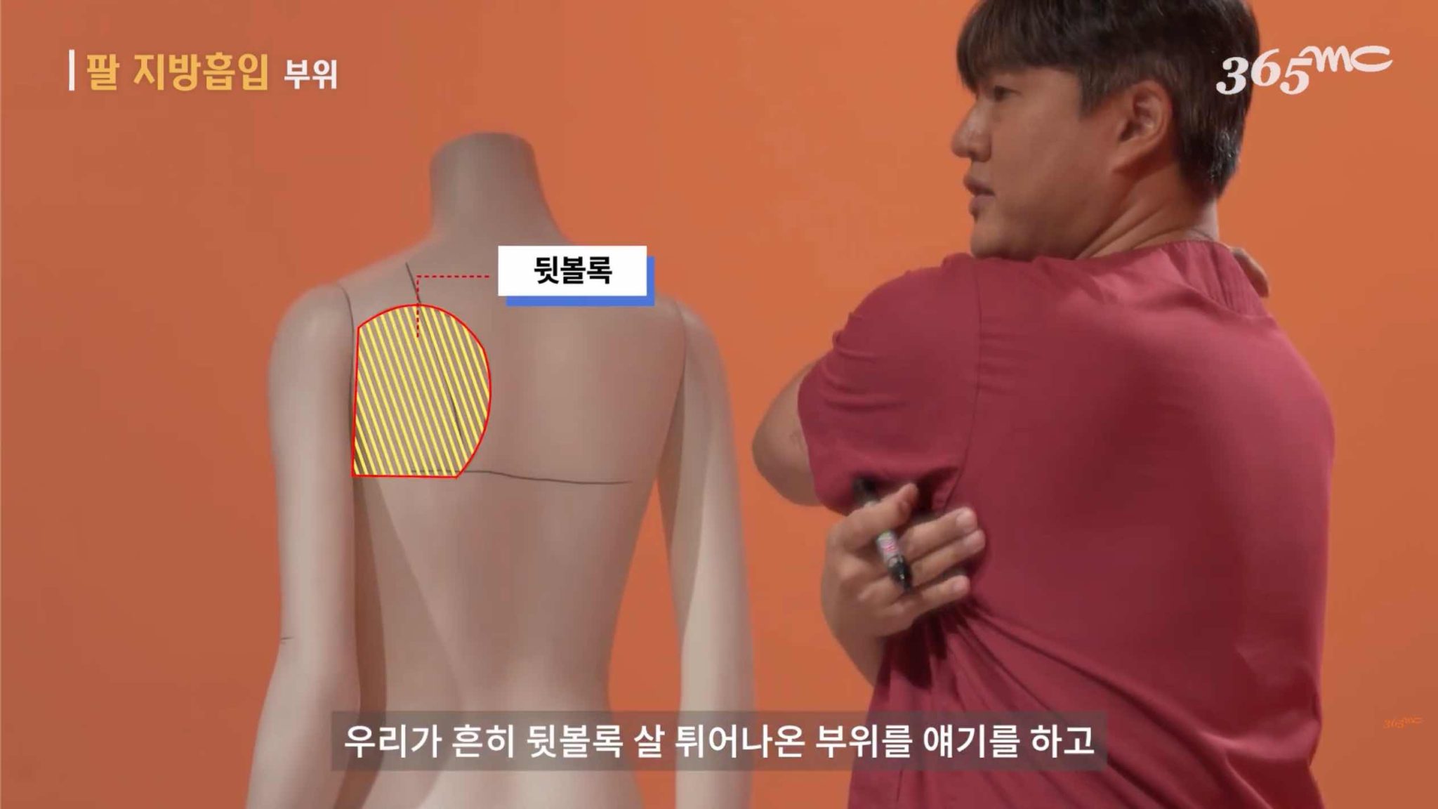 A Full Guide To Full Body Liposuction in Korea - 365mc Liposuction Clinic